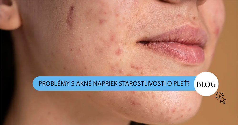 Problémy s akné napriek starostlivosti o pleť? Riešením môže byť ...